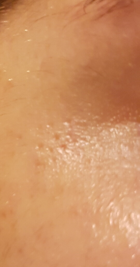 Electrolysis-related skin indentation - Professional Electrolysis ...