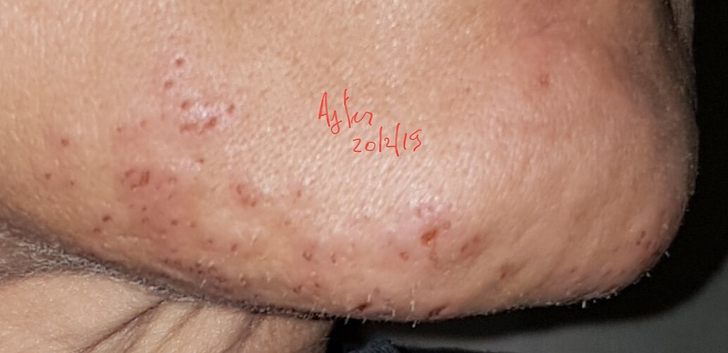 Question about chin hair and scarring post electrolysis - #3 by ...
