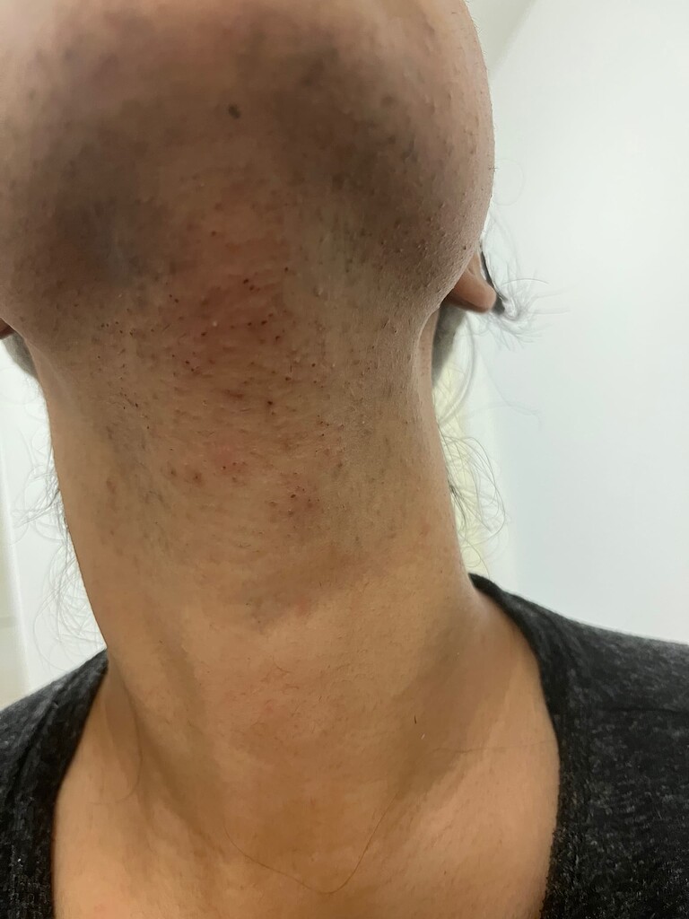 Help! Is this scaring after electrolysis? - Professional Electrolysis ...