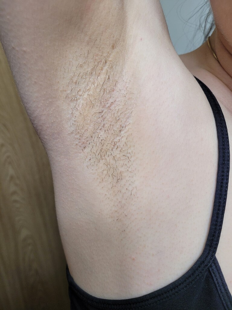 Ketsele’s Progress Photojournal - Page 2 - Professional Electrolysis - Hairtell hair removal ...