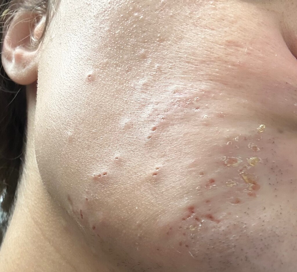 Are these normal results a few hours after an electrolysis session ...