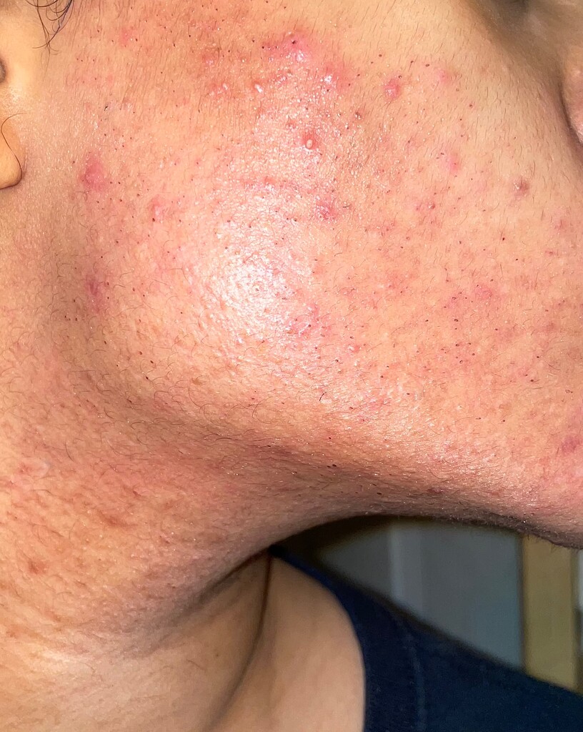 Is this scabbing/ scarring normal? - Professional Electrolysis ...