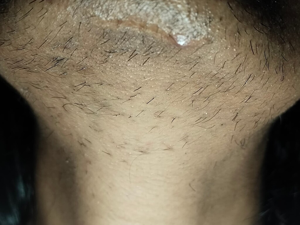 Severe scarring post electrolysis - Professional Electrolysis ...