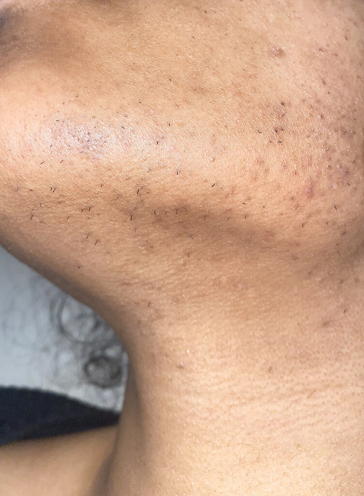 Wondering what options I have to reduce hyperpigmentation ...