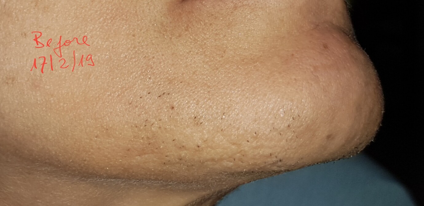Question about chin hair and scarring post electrolysis - #3 by ...